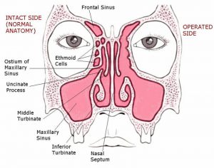 Before and after sinus surgery - Indigo Health